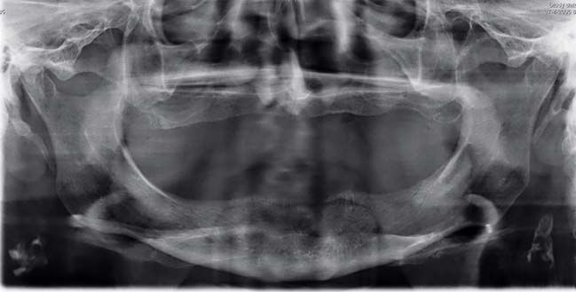 Panoramische röntgenfoto toont slagaderverkalking - NRC