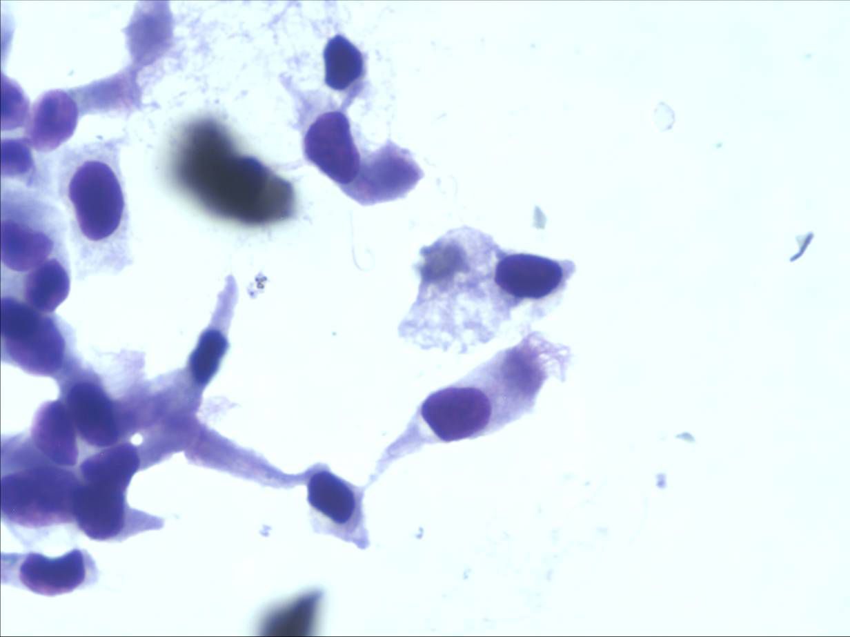 Opsporen voorstadium longkanker maakt ingrijpen mogelijk - NRC