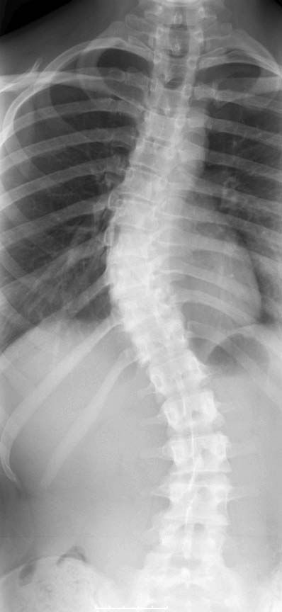 Kromme rugcontrole - NRC