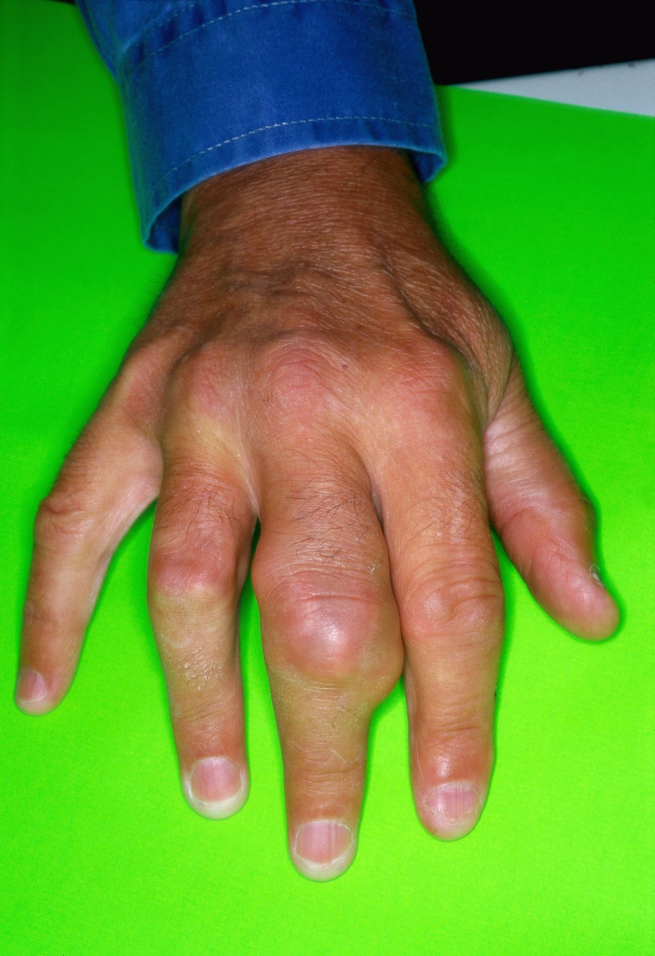 Bevolkingsonderzoek onthult genetische achtergrond van jicht - NRC