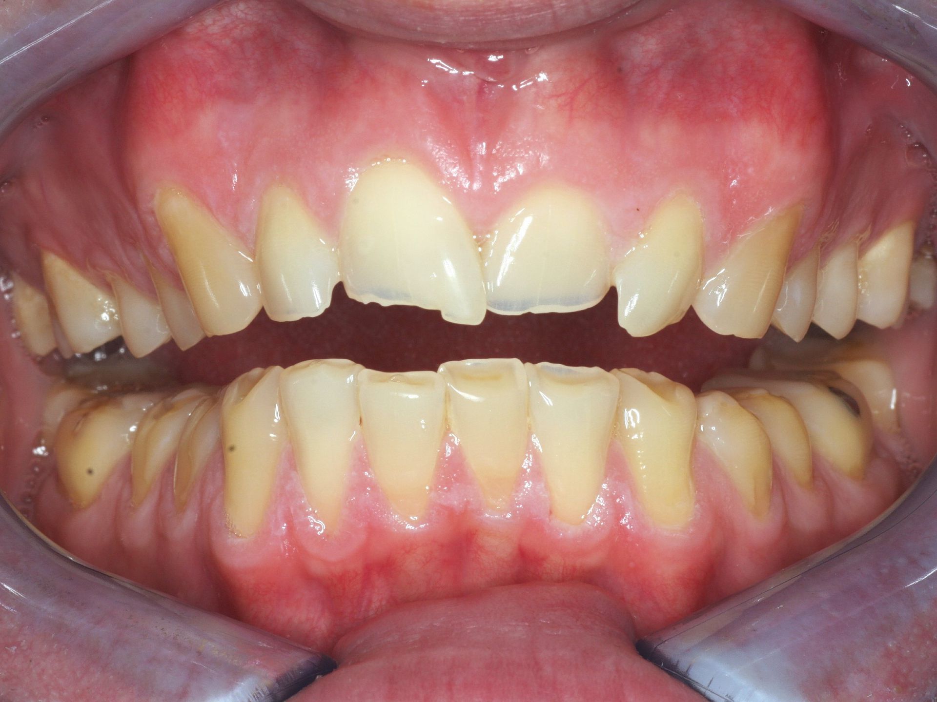 Dertig procent van jonge kinderen heeft last van slijtage van het gebit ...