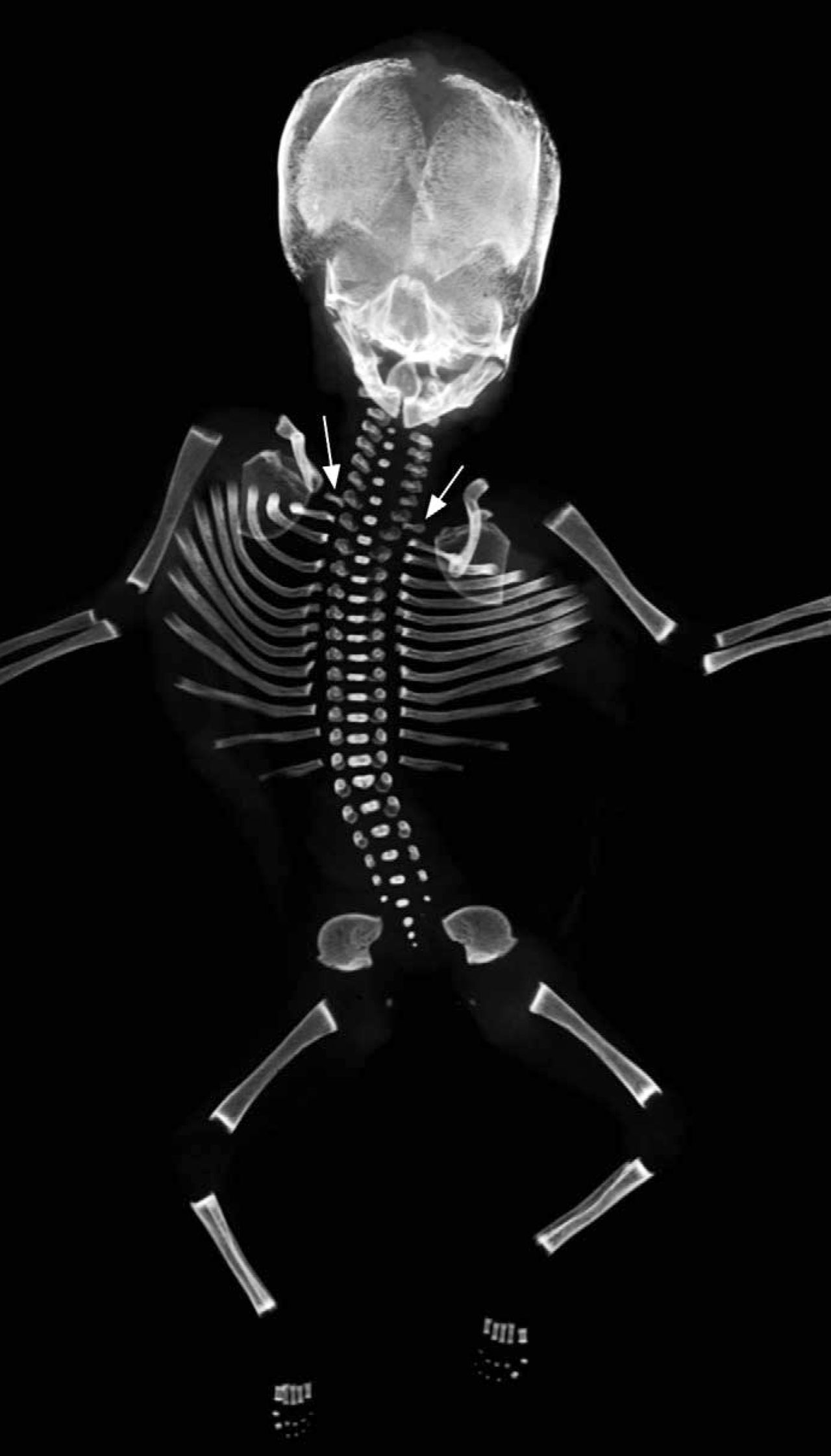 Rib aan halswervel duidt op miskraam - NRC