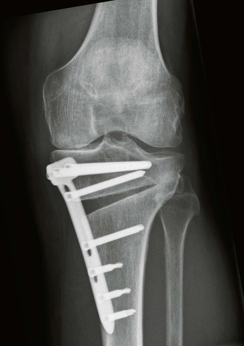 Correctie been vaak beter dan kunstknie - NRC