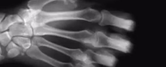 Video: dit gebeurt er als je je vingers knakt. En is het nou slecht? - NRC