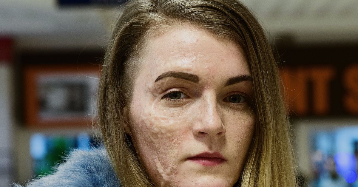 Hoe te leven met littekens - NRC