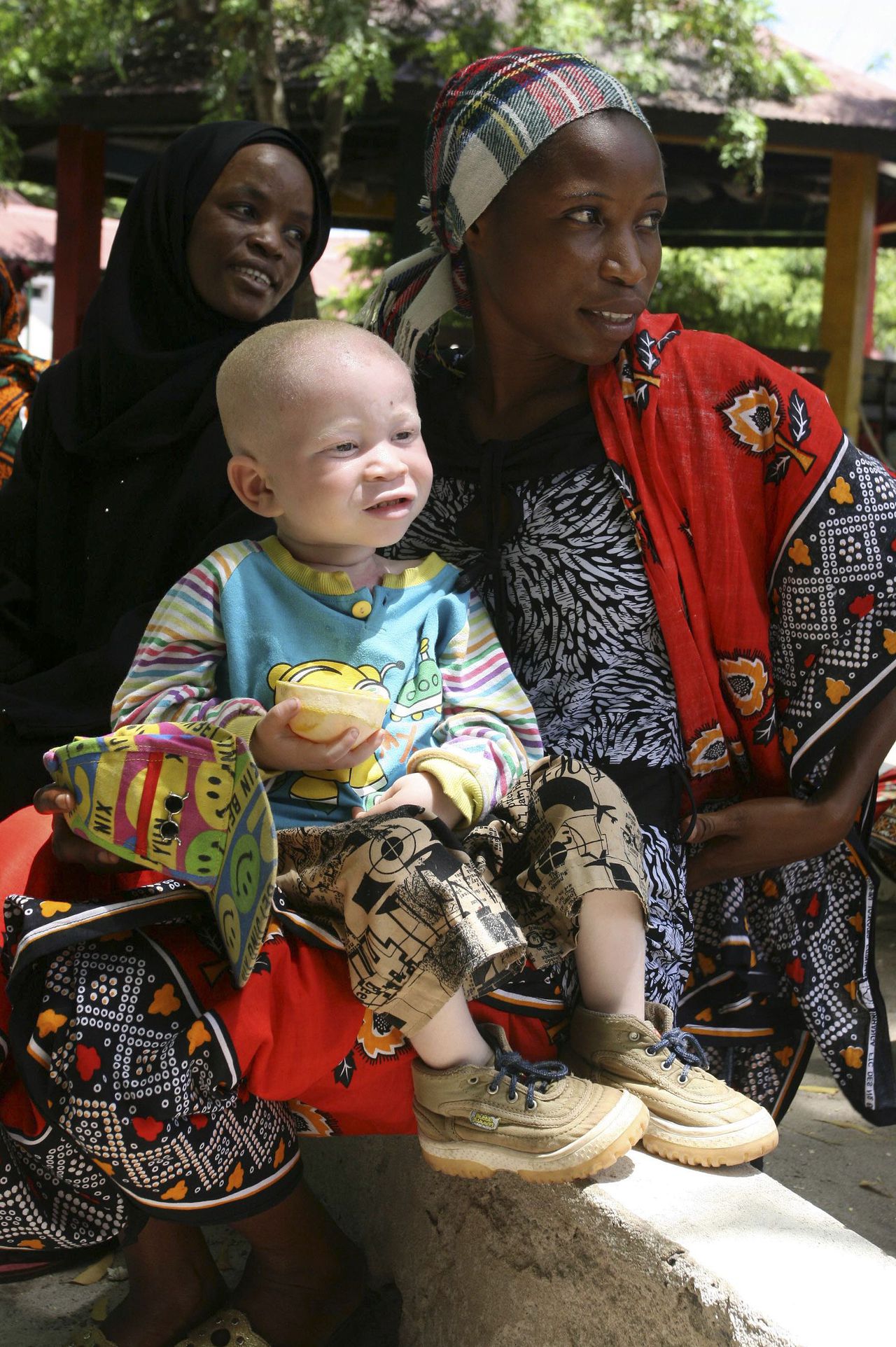 Voor albino's is Afrika een vloek - NRC