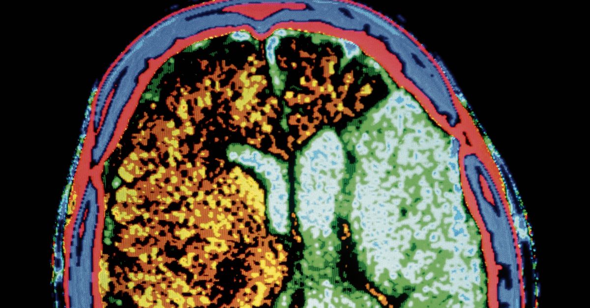 Eén enzym maakt hersenen gevoelig voor zuurstoftekort - NRC